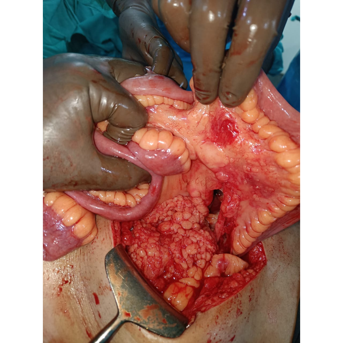 Abdominal Trauma Treatment in Indore | Expert Gastroenterologist Care | Dr. Amit Ganguly